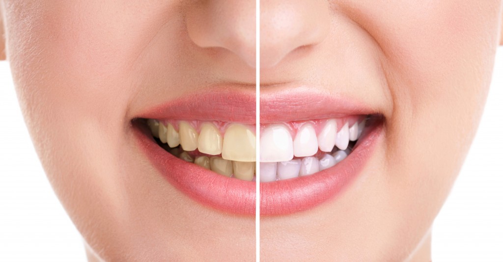 Produse alimentare care distrug smalțul dentar - ea.md
