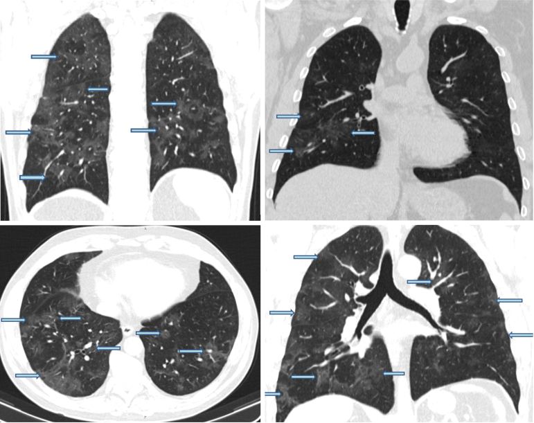 75% dintre pacienții cu cancer bronhopulmonar sunt diagnosticați tardiv ...